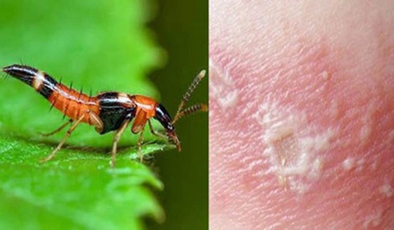 Trị Như Thế Nào Khi Bị Côn Trùng Cắn Nổi Mụn Nước Pestcontrol
